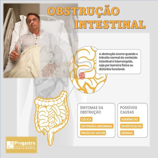 Obstrução Intestinal por ADERÊNCIAS – Instituto PROGASTRO