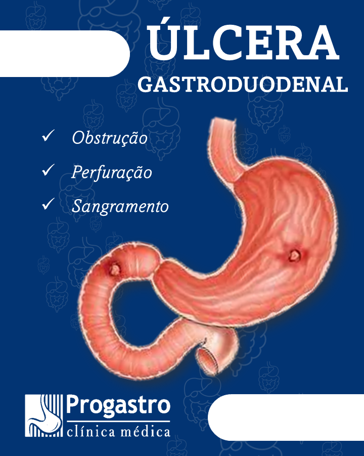 Tratamento cirúrgica da ÚLCERA GASTRODUODENAL – Instituto PROGASTRO